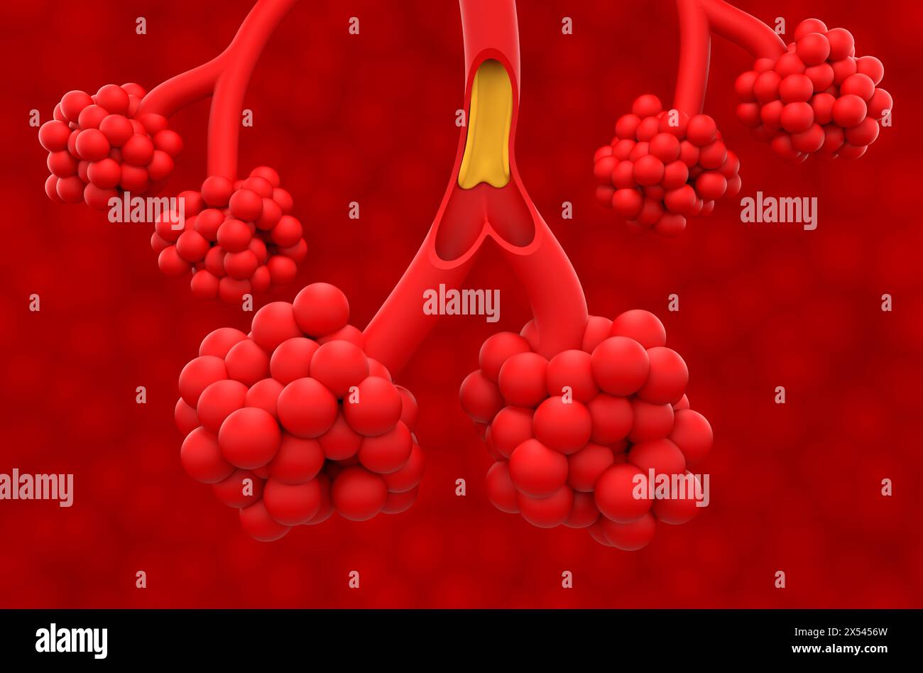 Cystic Fibrosis Cf Isometric View 3d Illustration Stock Photo Alamy