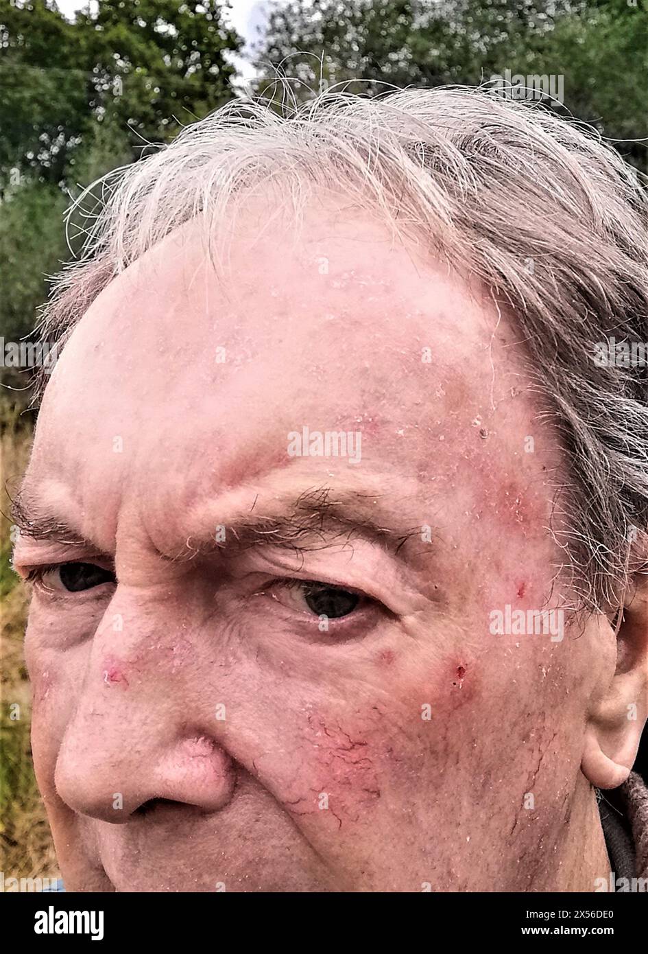 Dermatitis eczema face rash hi-res stock photography and images - Alamy