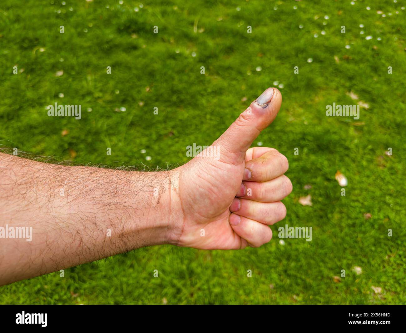 Man showing injured thumb up on grass background, closeup, injured male ...