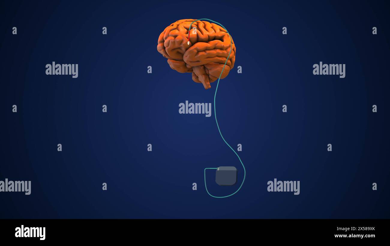 Deep brain stimulation as a medical concept Stock Photo - Alamy