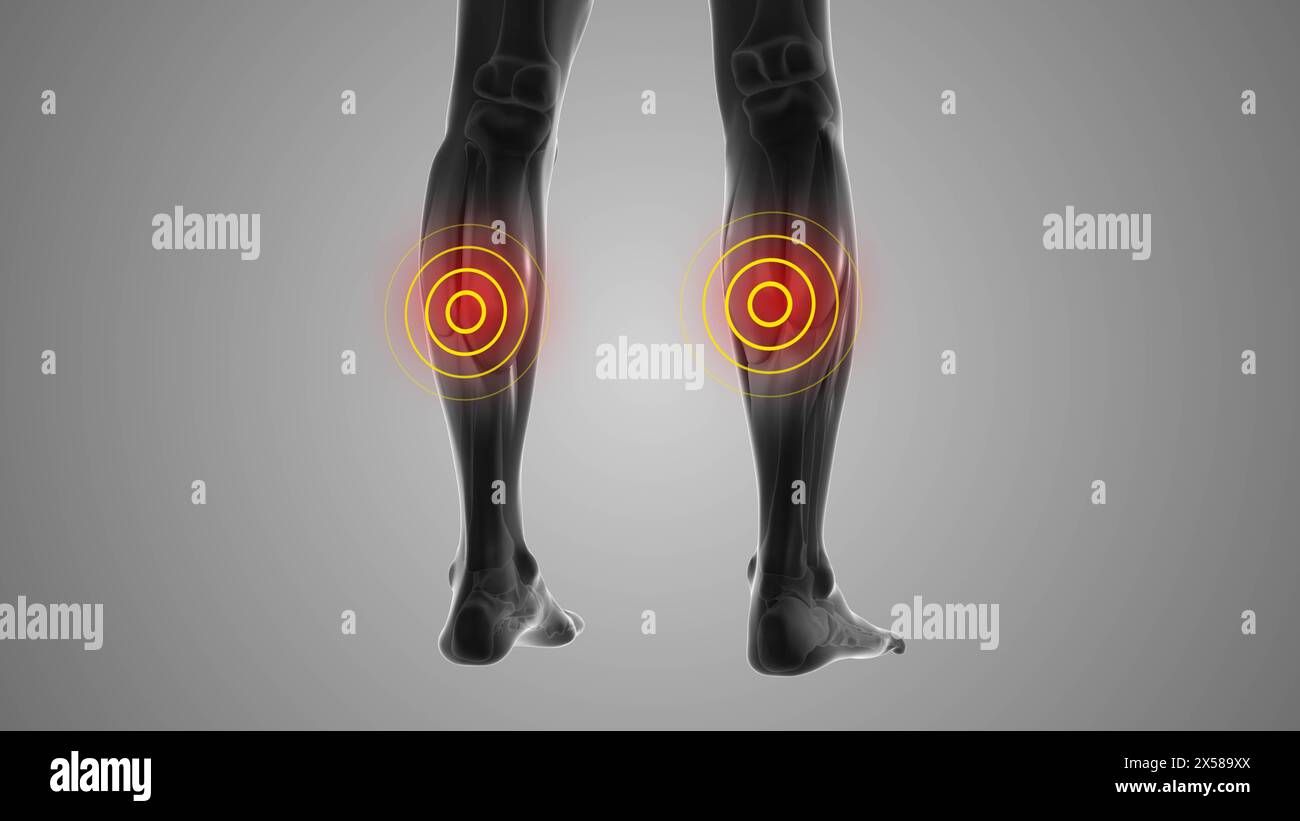 Leg calf discomfort that trigger pain Stock Photo - Alamy