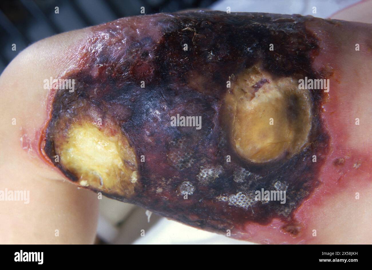 Leg ulcers caused by pyoderma gangrenosum, a rare skin condition. This patient has had dead ...