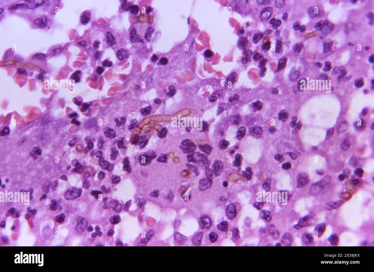 Light micrograph of brain tissue containing fungal filaments known as ...