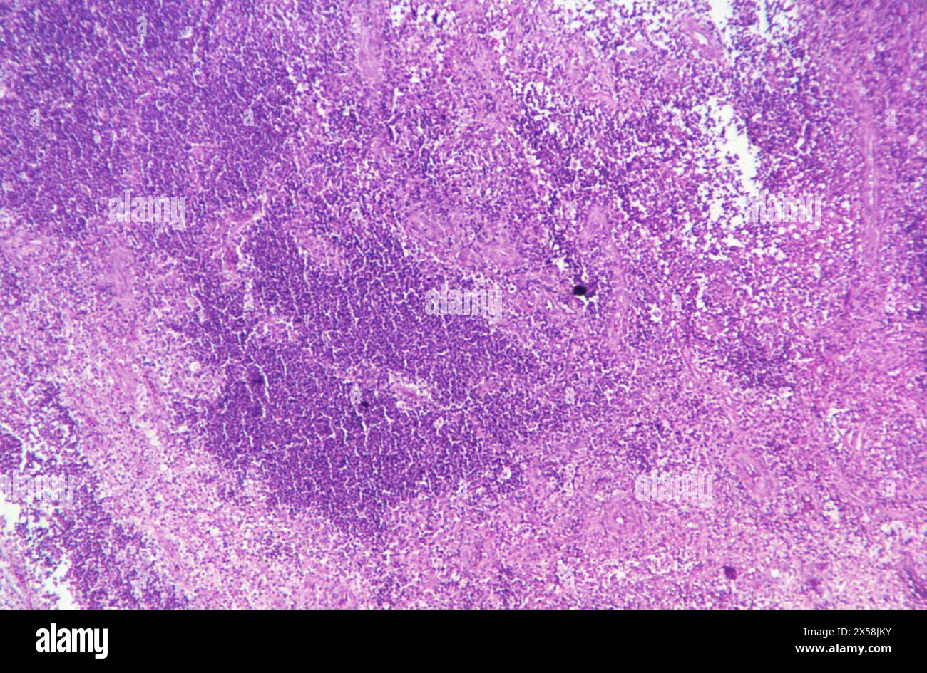 Stained light micrograph showing a tissue sample from a patient with ...