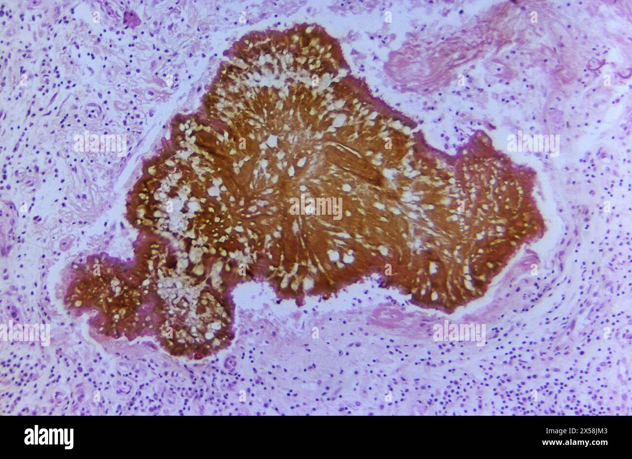 Stained light micrograph of a tissue specimen taken from a skin growth ...
