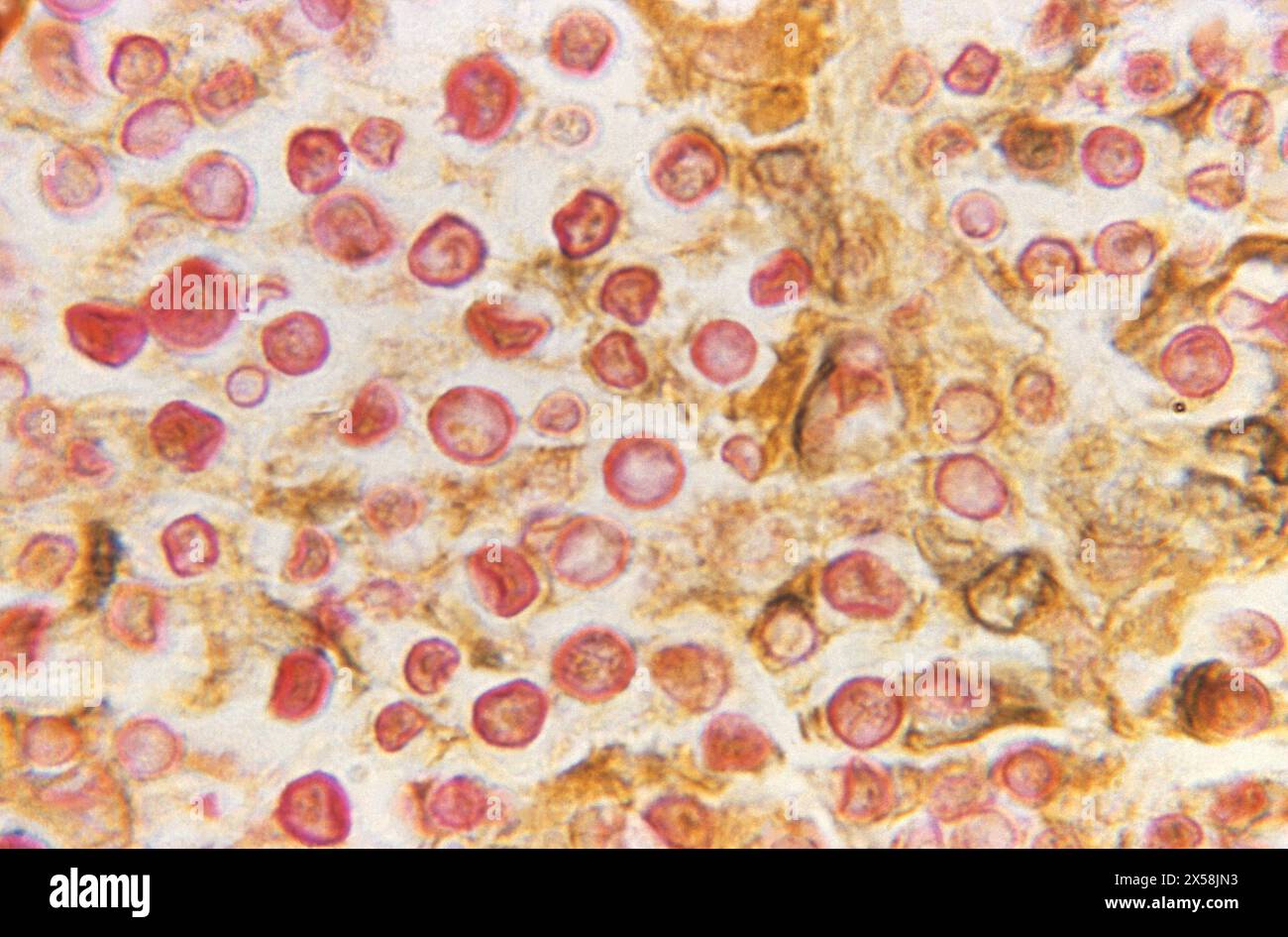 Stained light micrograph of a liver tissue sample from a patient with ...