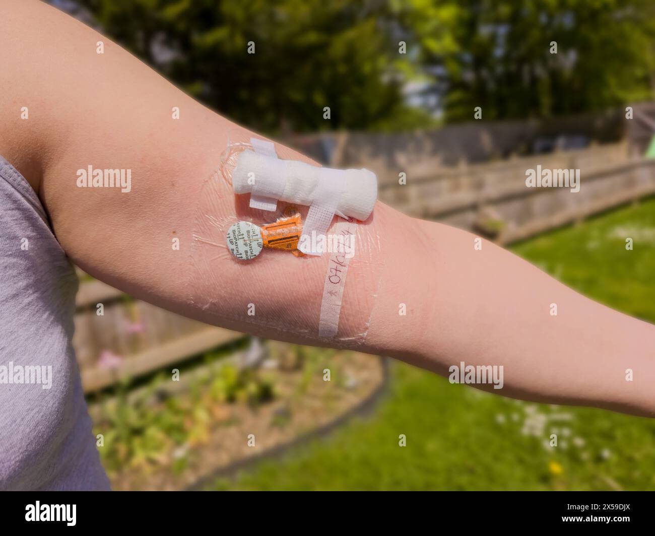 Picc line cancer hi-res stock photography and images - Alamy