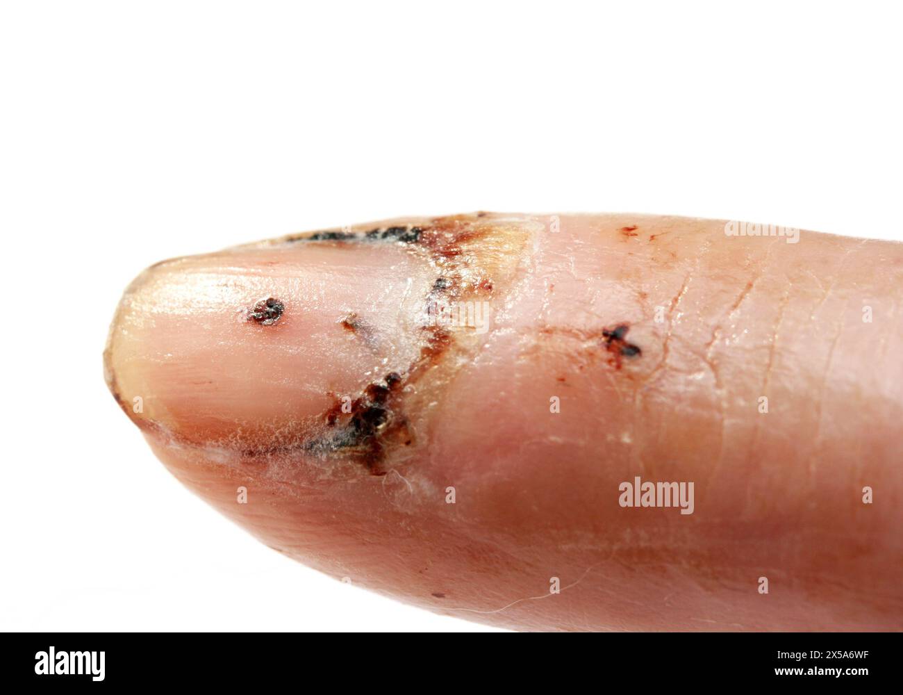 Wound repair hi-res stock photography and images - Alamy