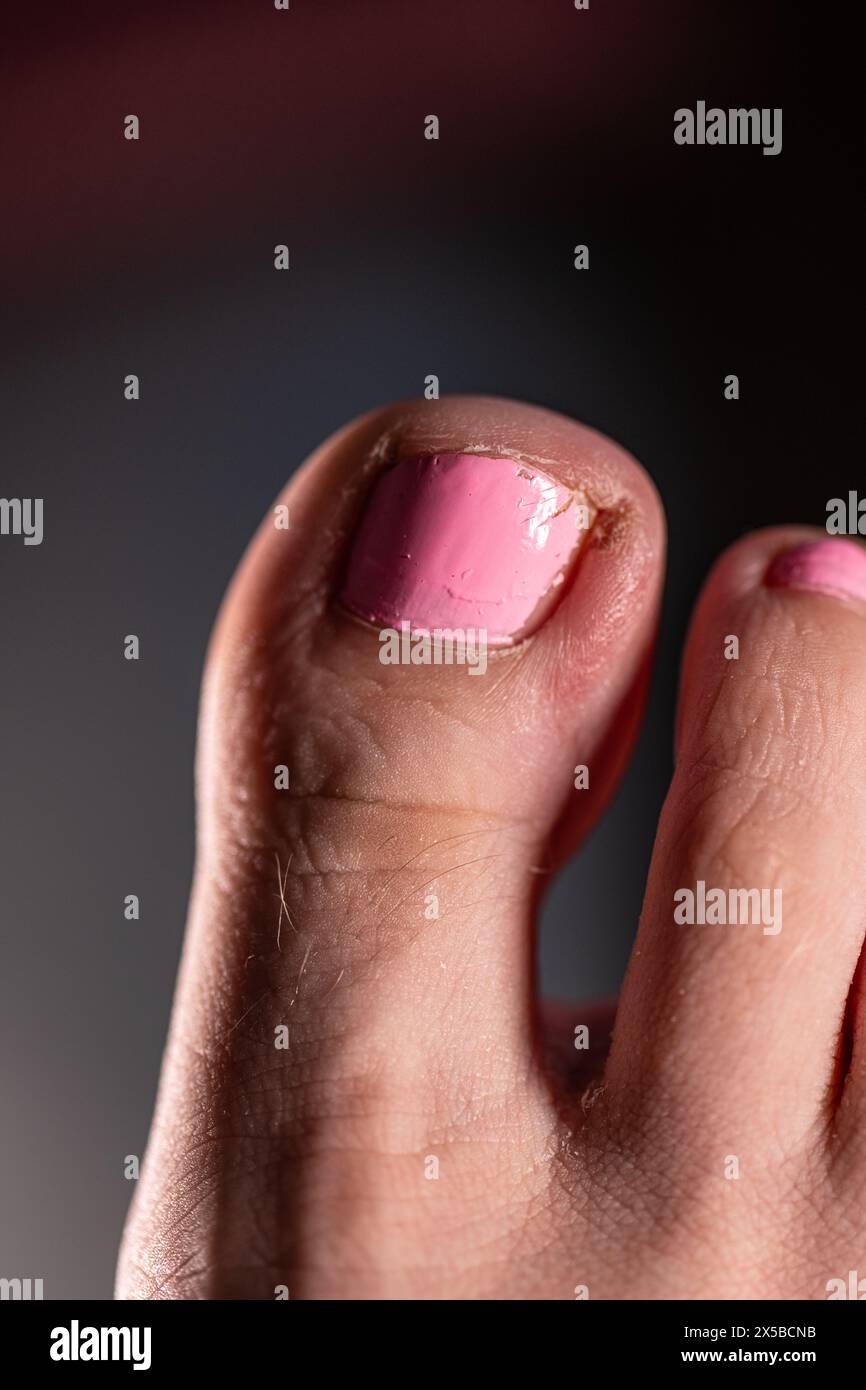 Infected right foot ingrown toenail Stock Photo - Alamy