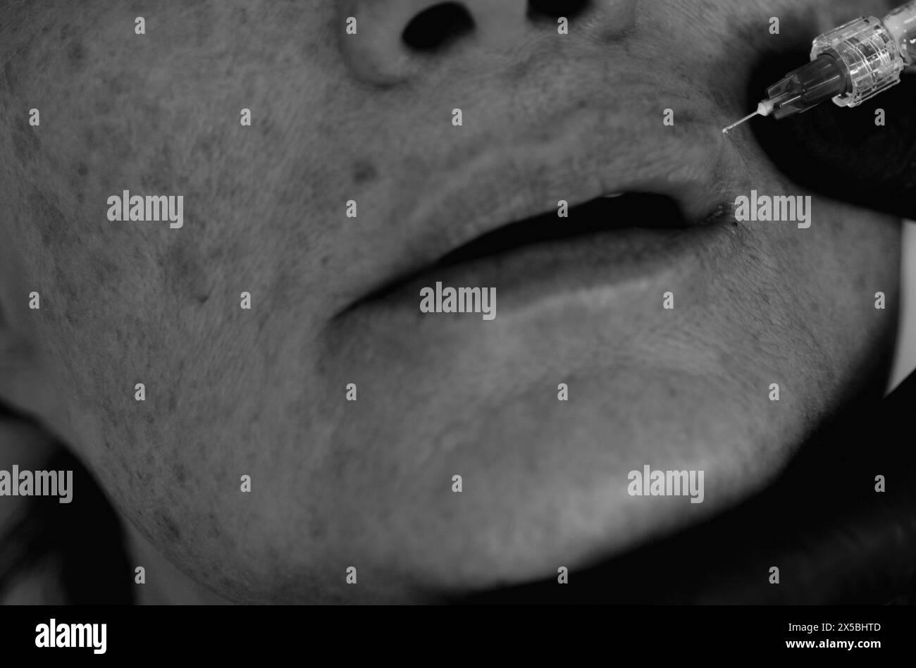 Filler Injections Closeup Mature Woman Lips Procedure Augmentation