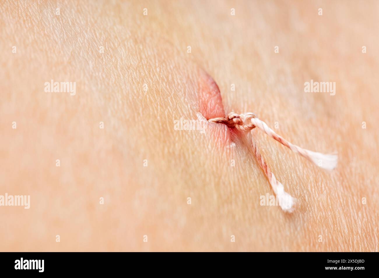 Medical suture with threads on the human body close-up Stock Photo - Alamy