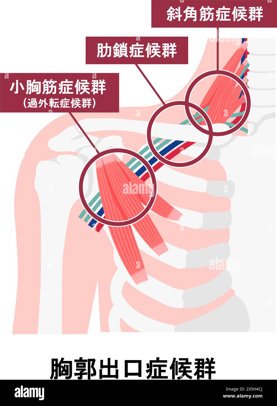 Vector illustration of where thoracic outlet syndrome occurs Stock ...