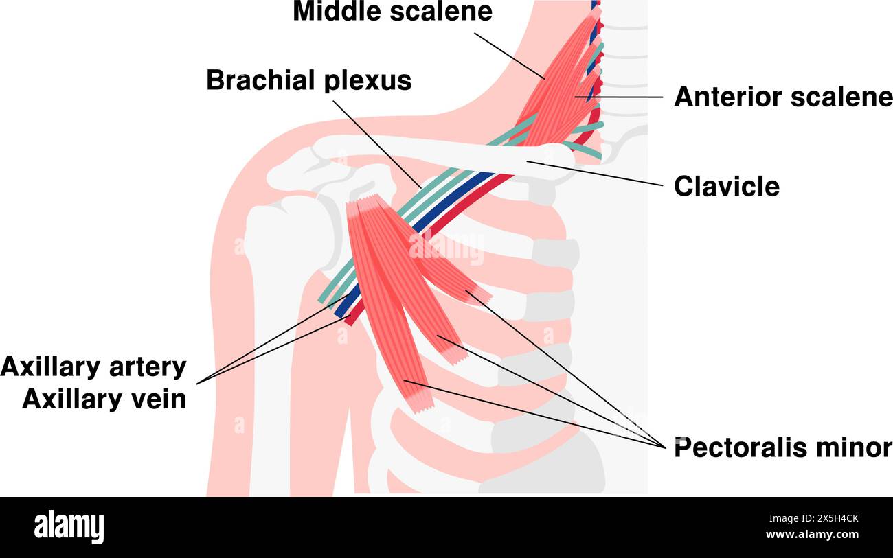 Vector illustration of where thoracic outlet syndrome occurs Stock ...