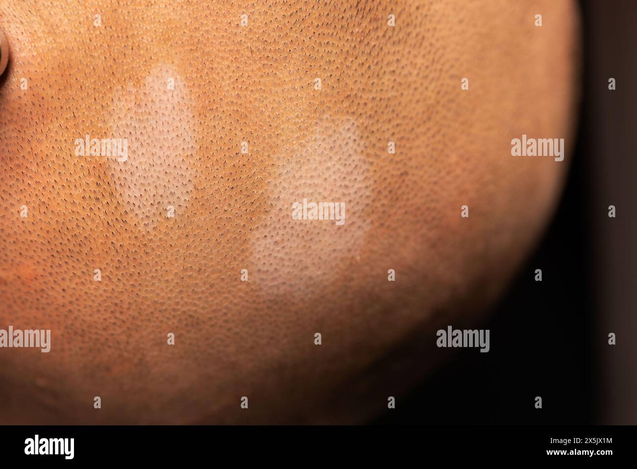 Close-up view of hypomelanotic macule or white spot on the scalp in ...