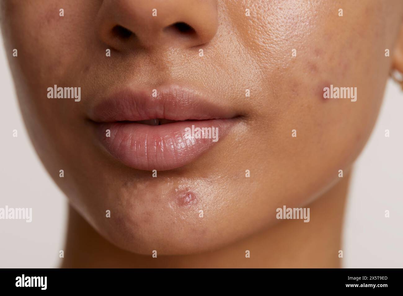 Acne face hi-res stock photography and images - Alamy