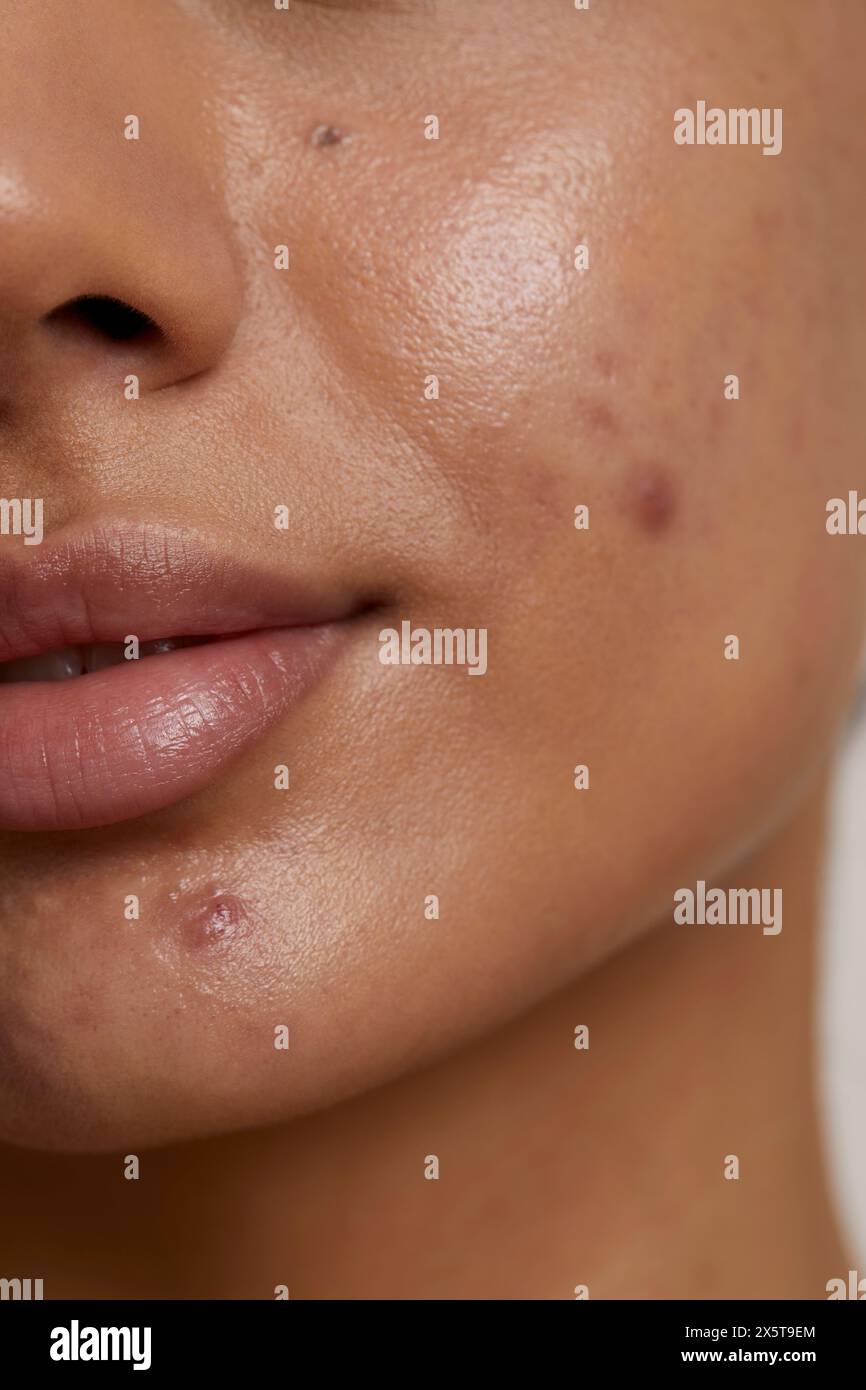 Close-up of woman face with acne Stock Photo - Alamy