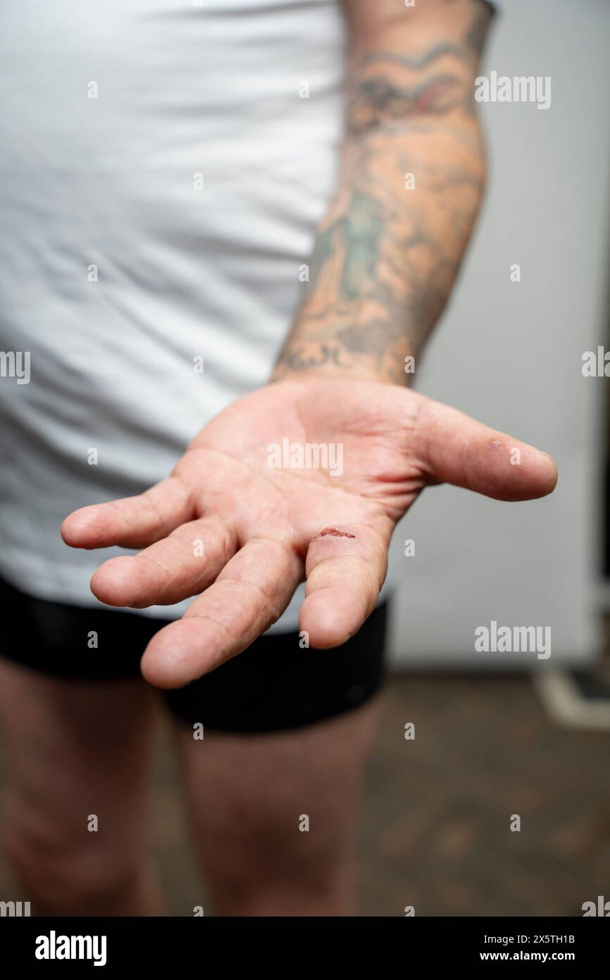 Scar hand hi-res stock photography and images - Alamy