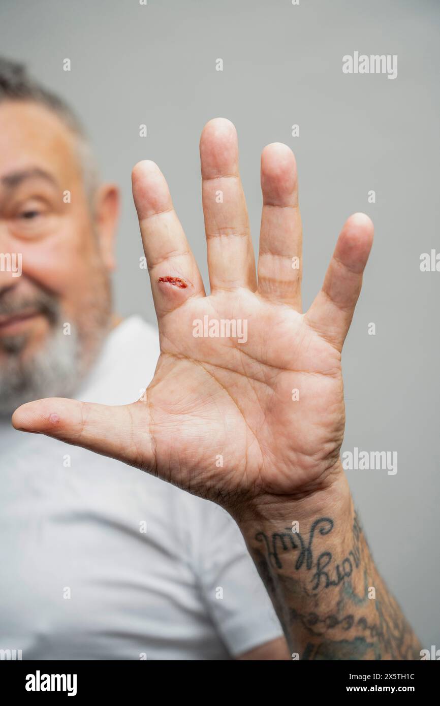 Scar hand hi-res stock photography and images - Alamy
