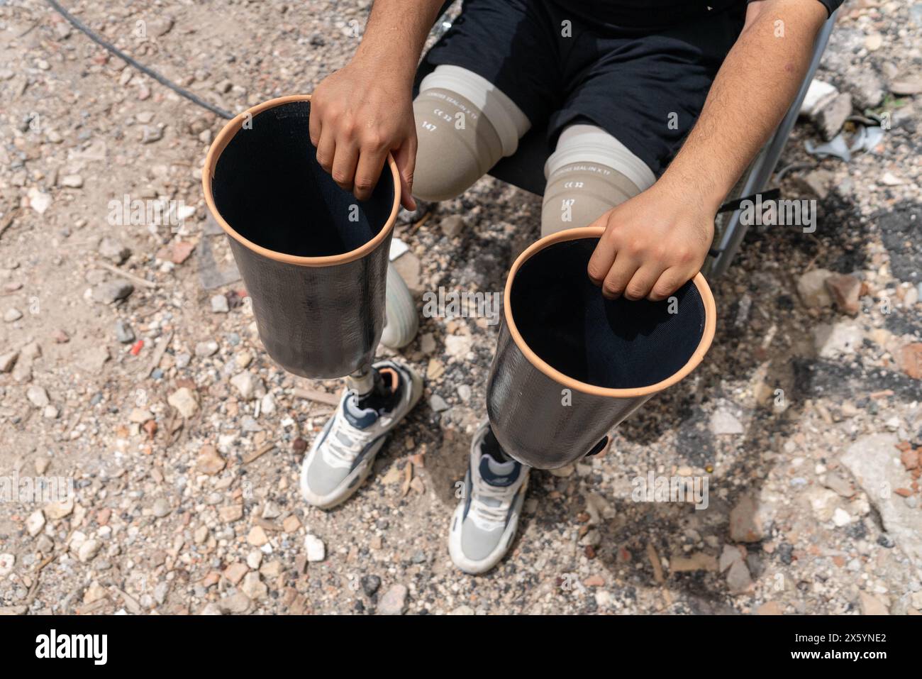 Honor holds the prostheses he used on his feet during the trip. Onur ...