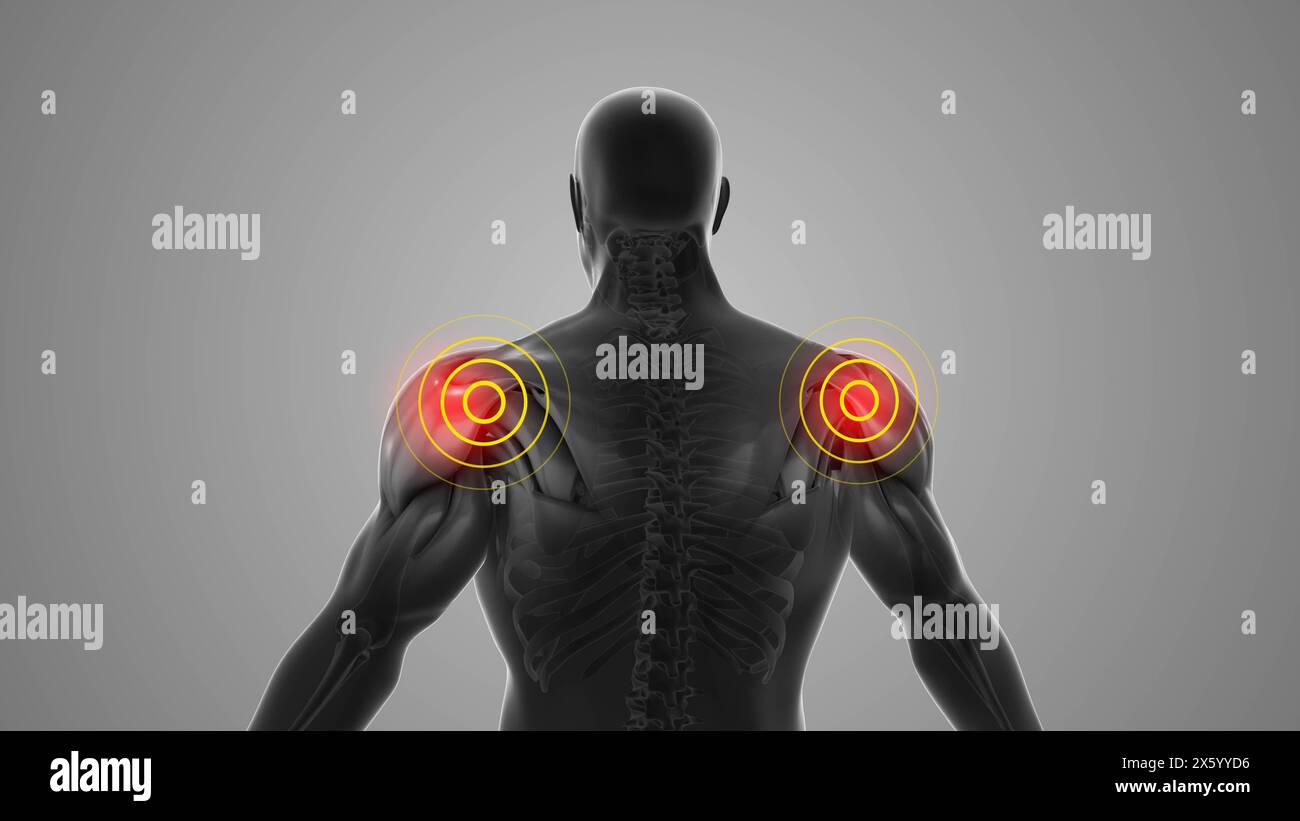 Shoulder discomfort that trigger pain Stock Photo - Alamy
