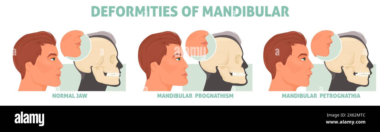 Deformities of mandibular with normal jaw, prognathism and petrognathia ...