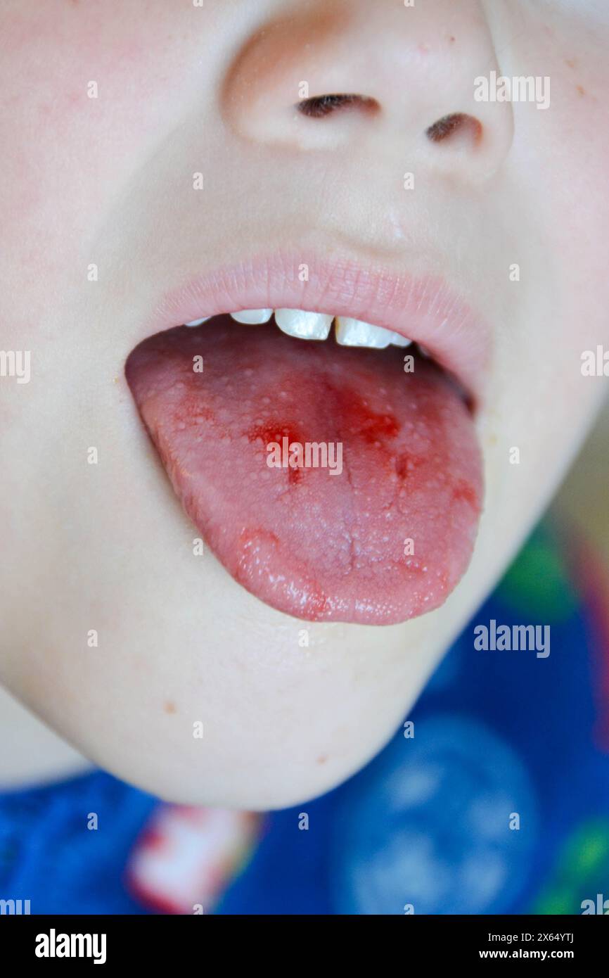 Close-up of lips, tongue, protrusion of blood. Child's bitten tongue ...