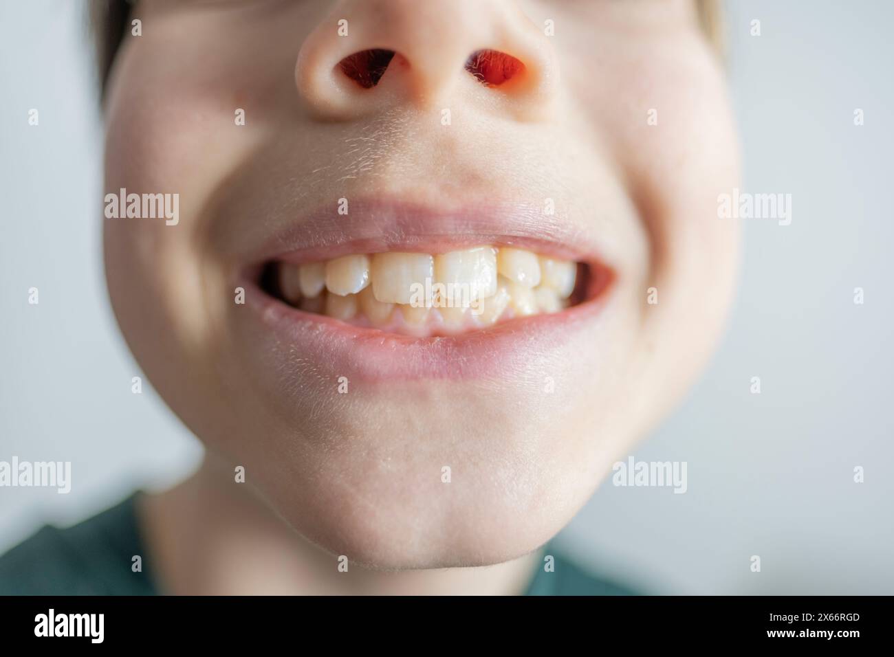 child 12 years old shows tooth sways and hurts, concept pediatric ...