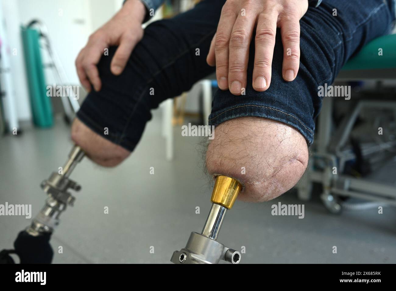 a man with bone-implanted leg prostheses. osteointegration Stock Photo ...