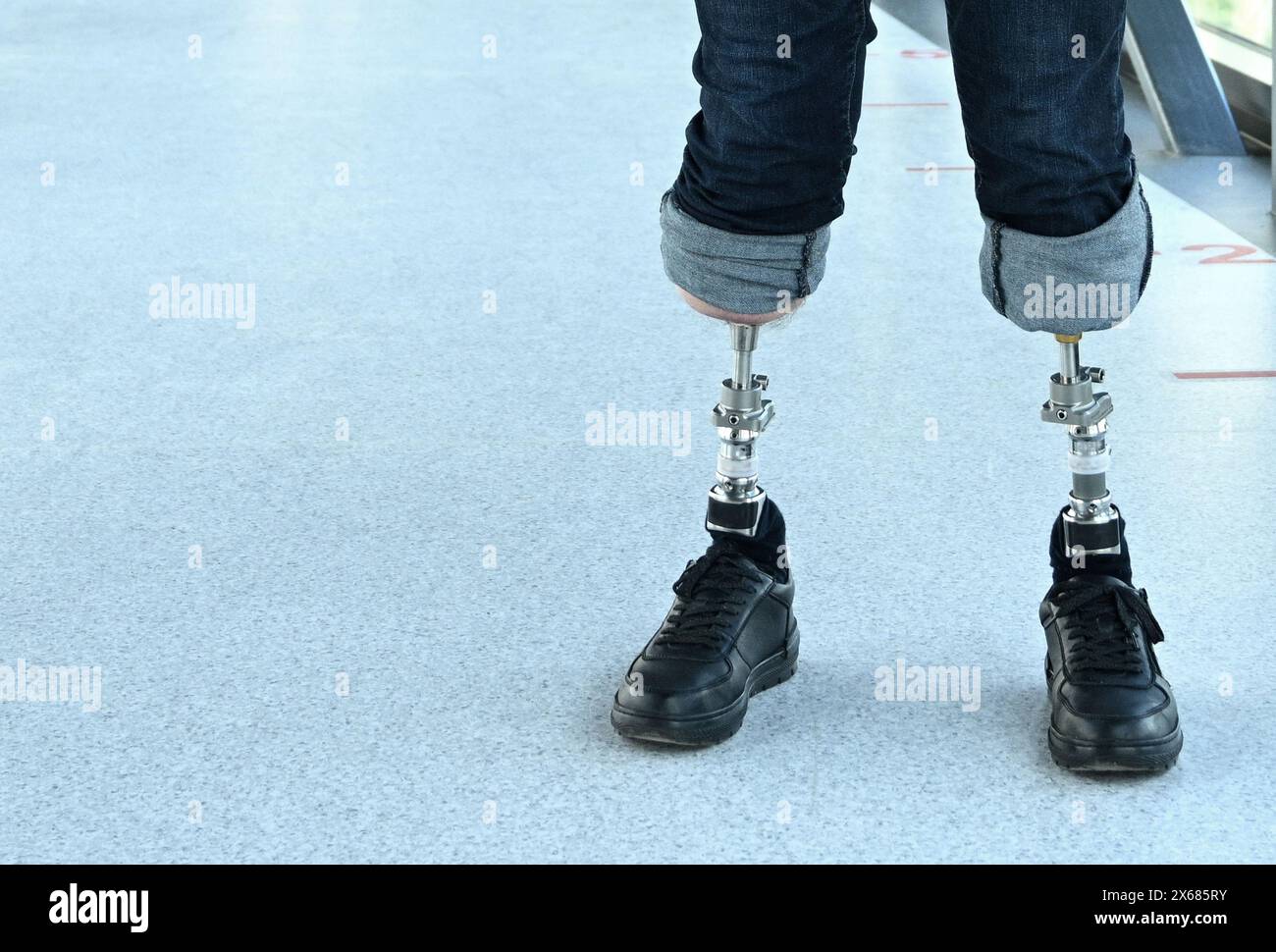a man with bone-implanted leg prostheses. osteointegration Stock Photo ...