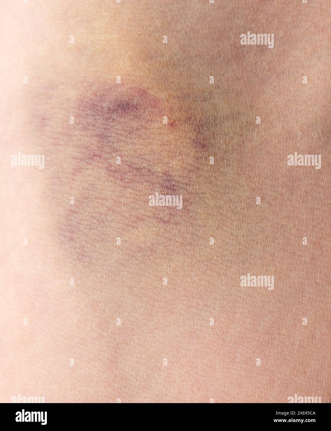 Hurt human skin texture with bruise macro close up view Stock Photo - Alamy
