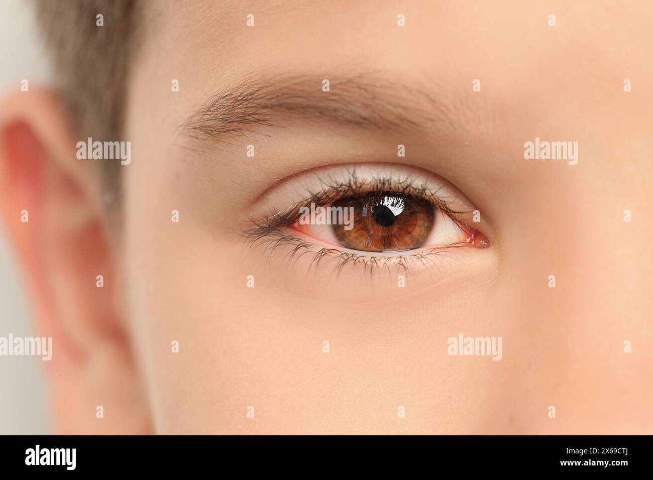 Little child suffering from conjunctivitis, closeup view Stock Photo ...