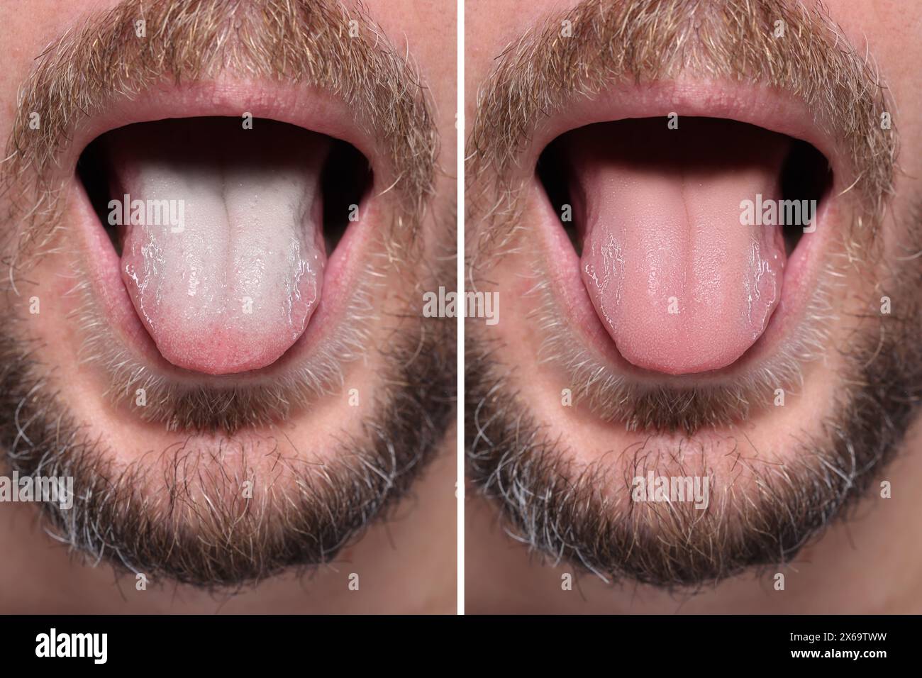 Man showing his tongue before and after cleaning procedure, closeup ...