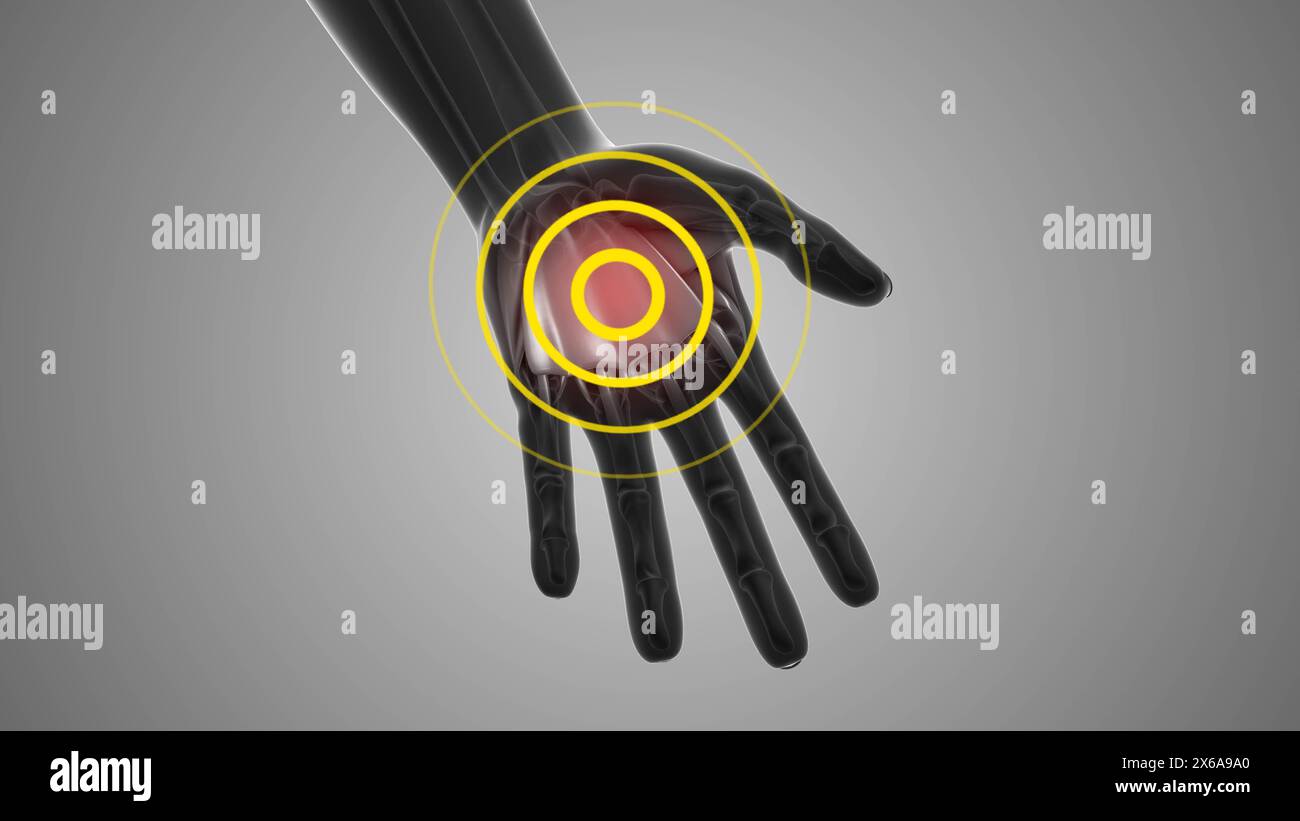 Hand palm discomfort that trigger pain Stock Photo - Alamy