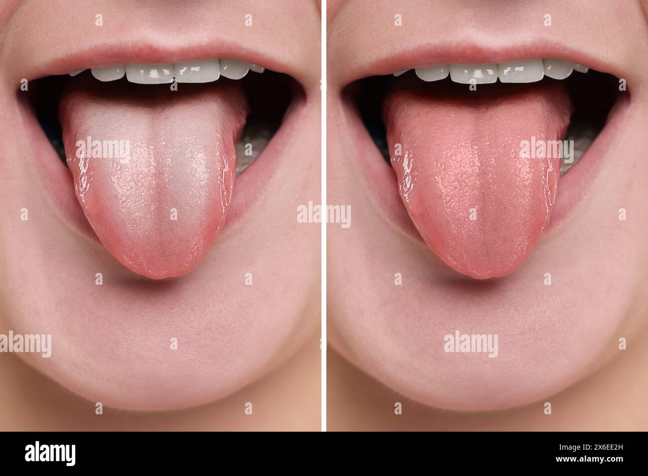Woman showing her tongue before and after cleaning procedure, closeup ...