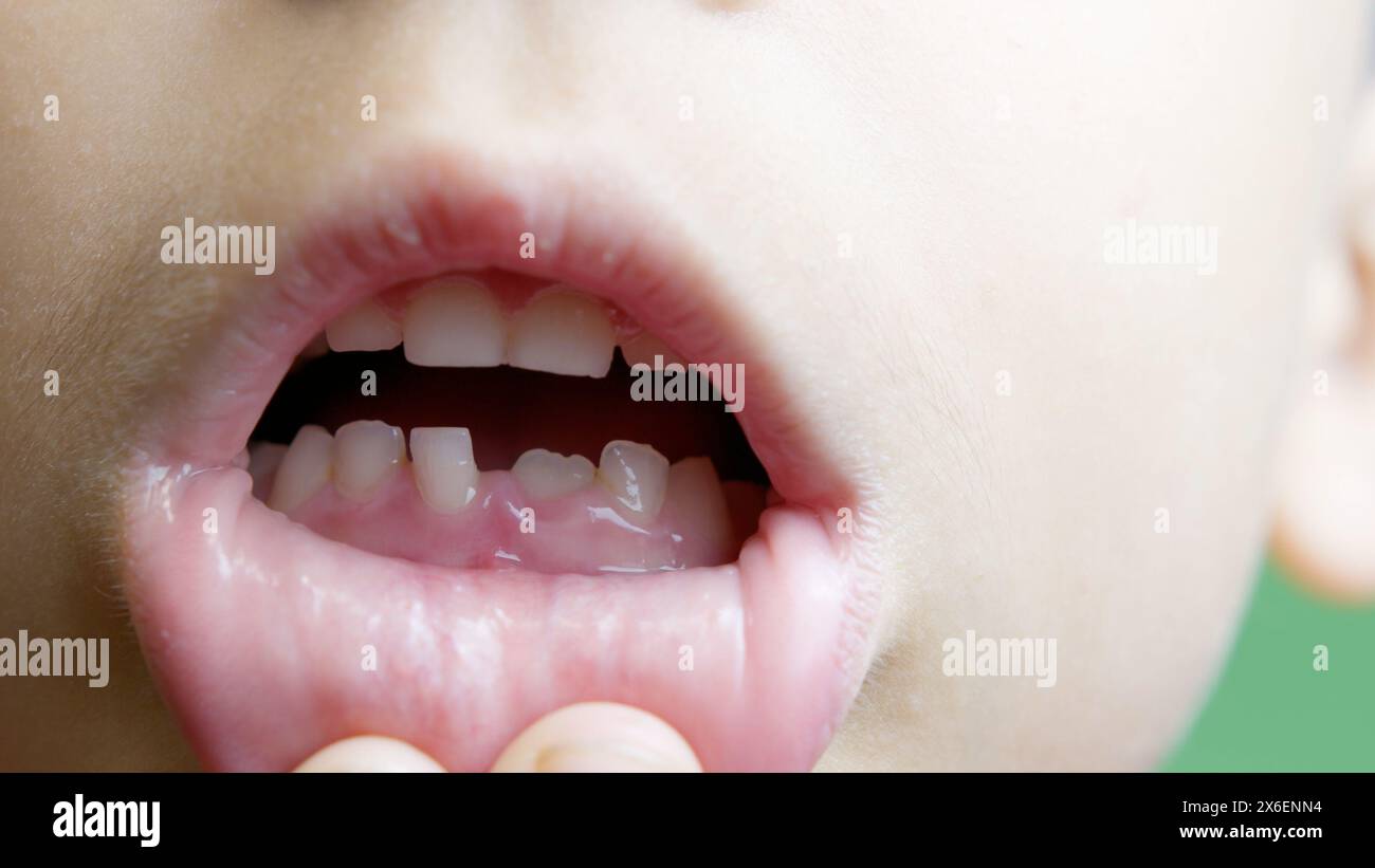 Close up, boy opens his mouth and shows his milky teeth. One missing ...