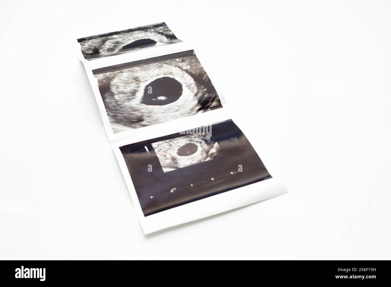 Ultrasound Picture Of 6 Weeks Fetus of Pregnant Woman, Embryo Image On ...