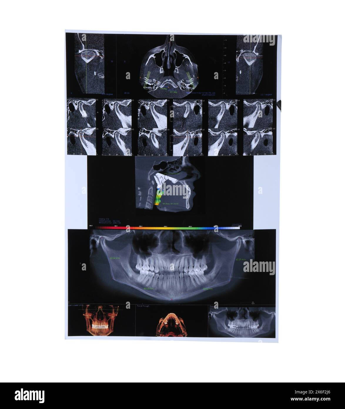 X-ray scans of human maxillofacial section for dental analysis isolated ...