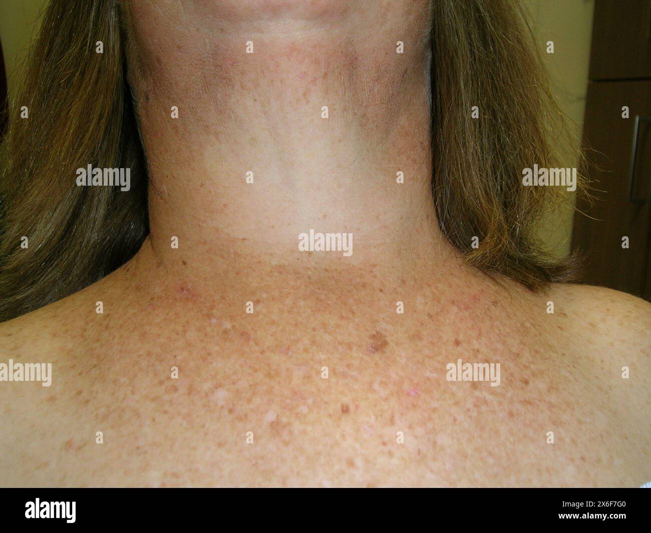 Neck of a 49 year old white female patient with Poikiloderma of Civatte ...