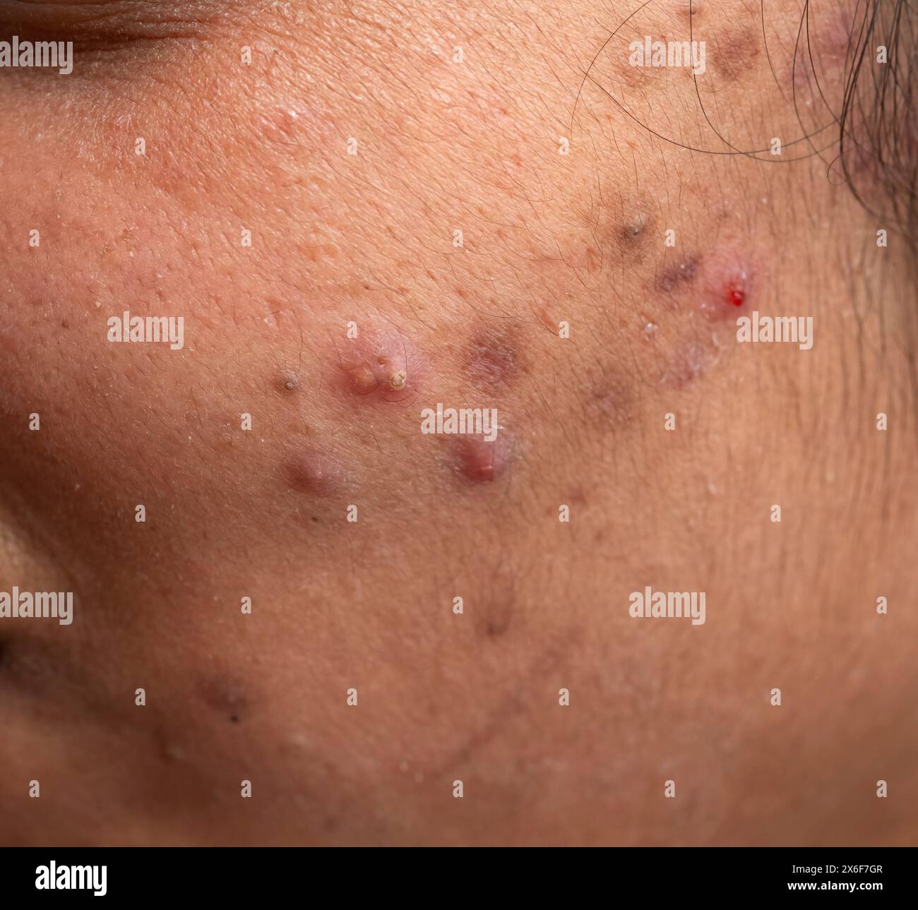 Acne vulgaris on a teenage girl's cheek. Acne is a general name given ...