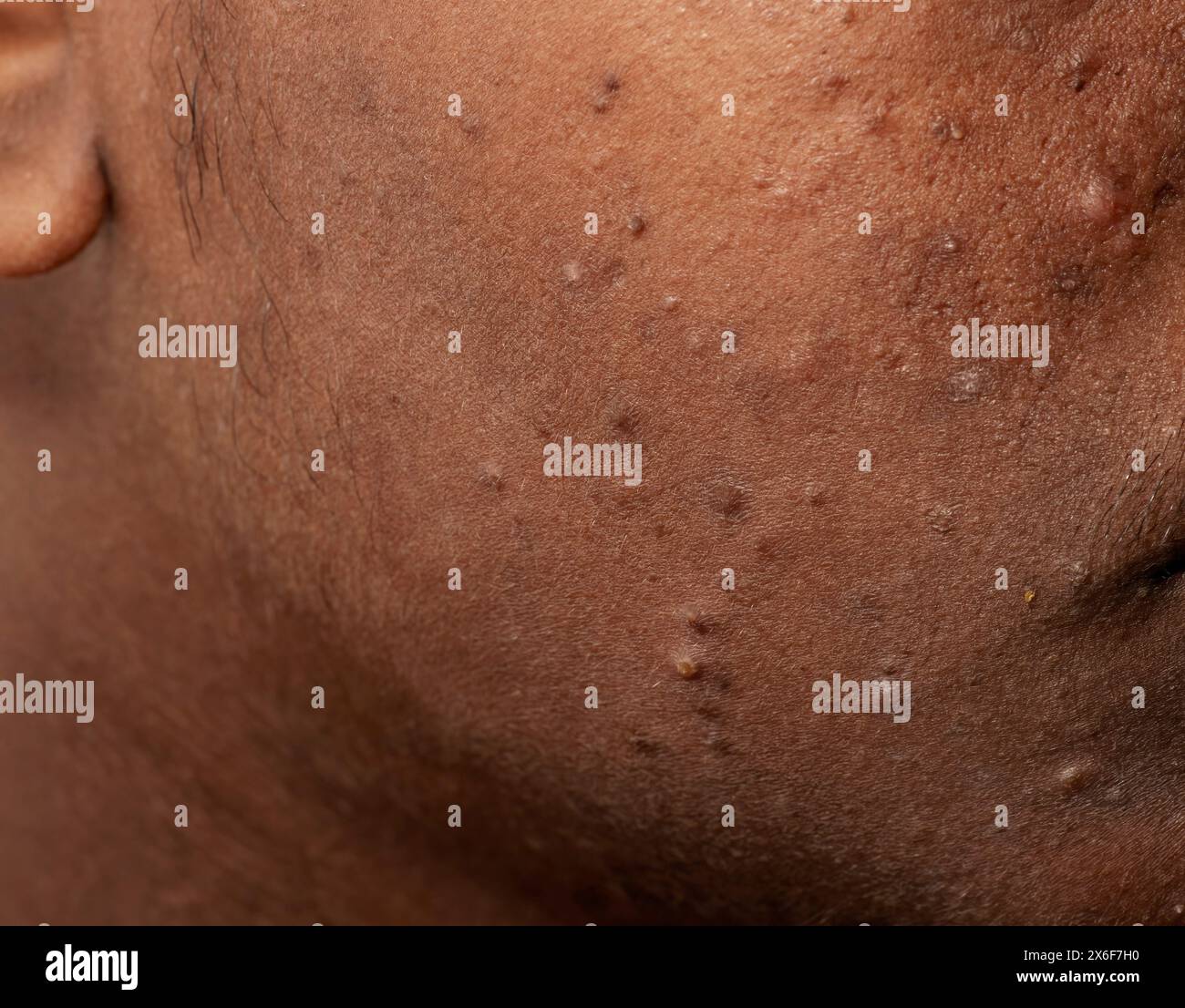 Acne vulgaris on a male patient's cheek. Acne is a general name given ...