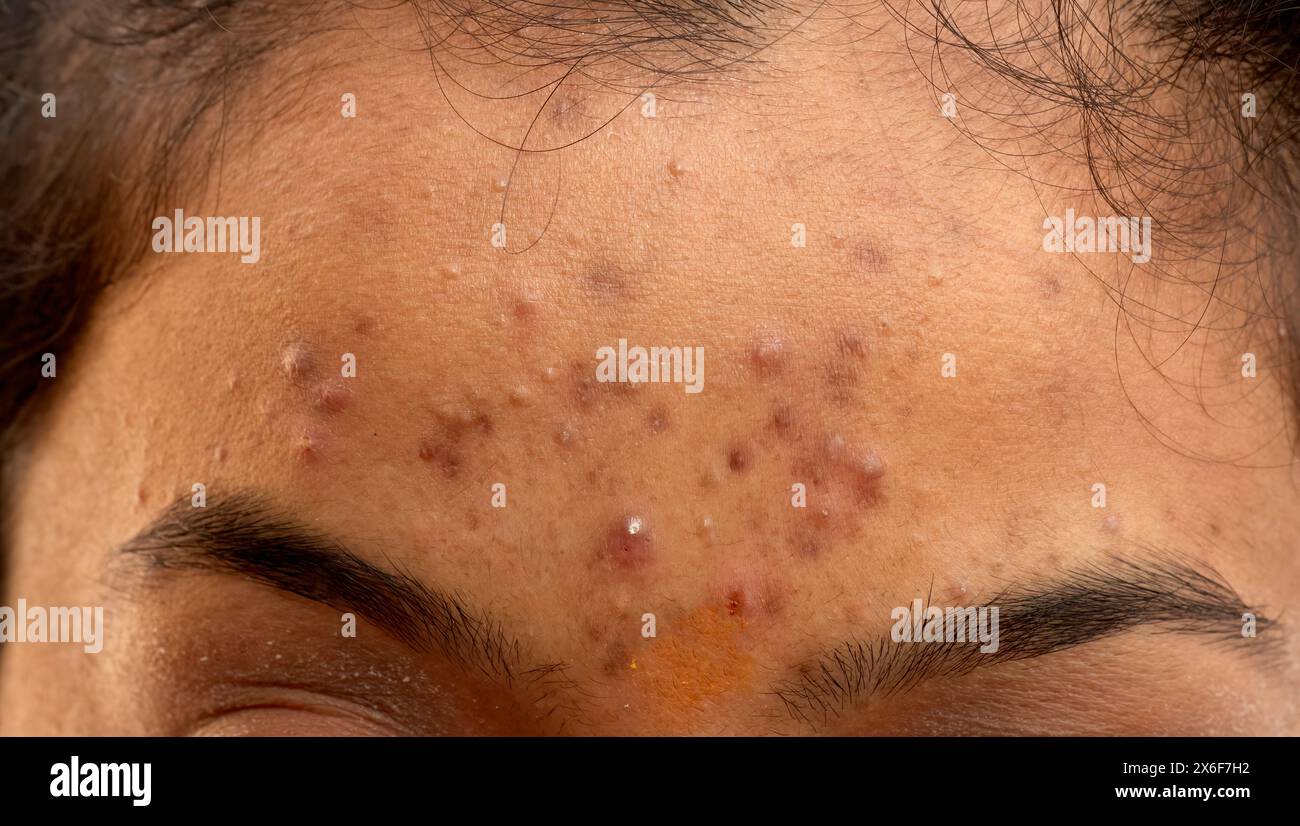 Acne vulgaris on a teenage girl's forehead. Acne is a general name ...
