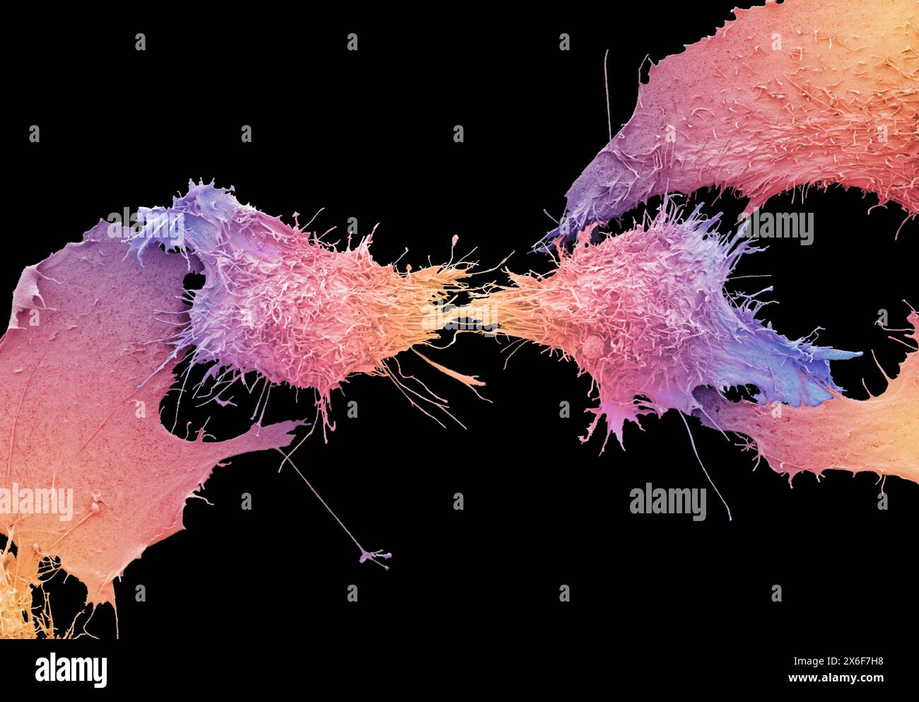 Cervical cancer cells dividing, coloured scanning electron micrograph ...