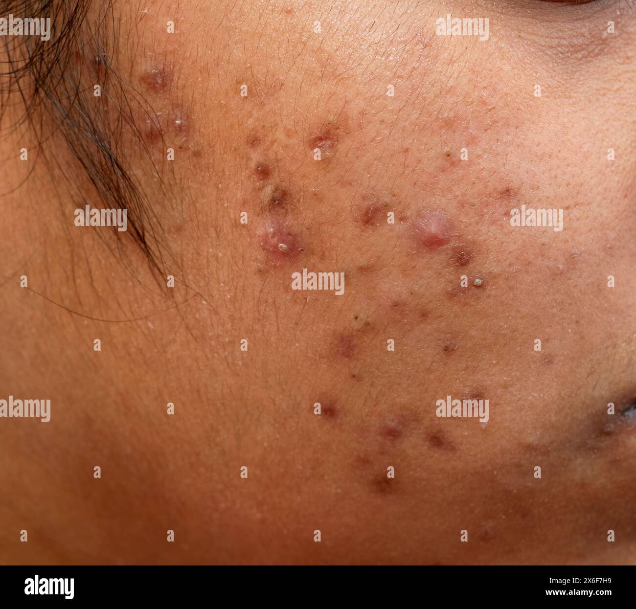 Acne vulgaris on a teenage girl's cheek. Acne is a general name given ...