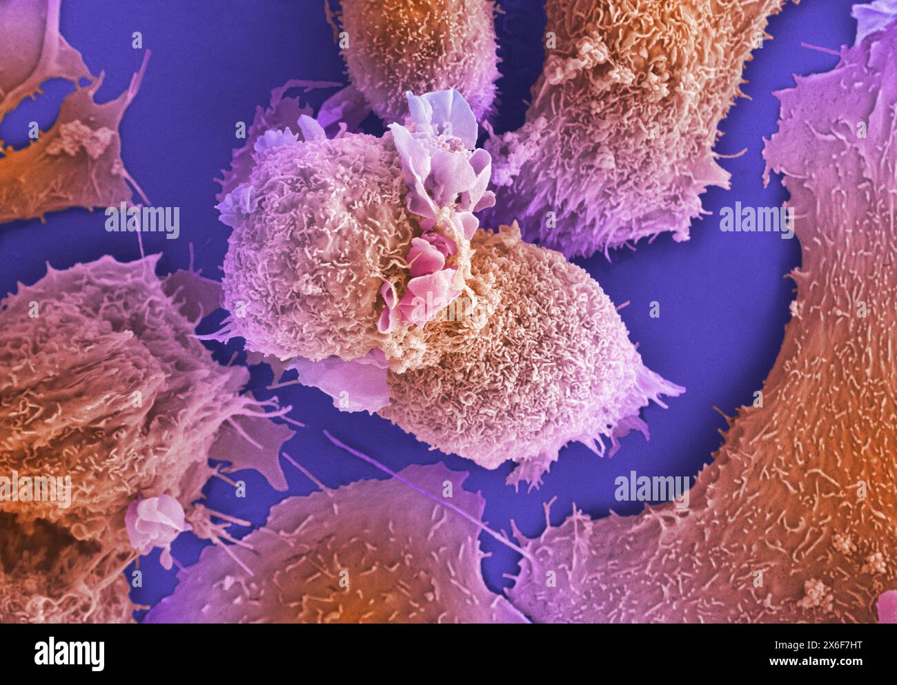 Lung cancer cells, coloured scanning electron micrograph (SEM). Lung ...