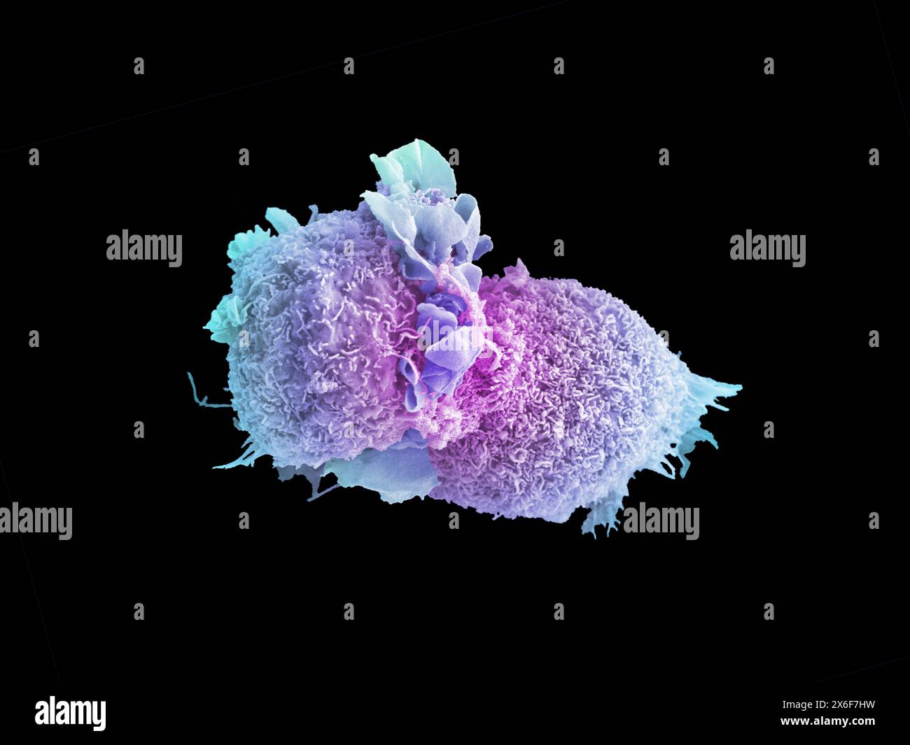 Lung cancer cells, coloured scanning electron micrograph (SEM). Lung ...