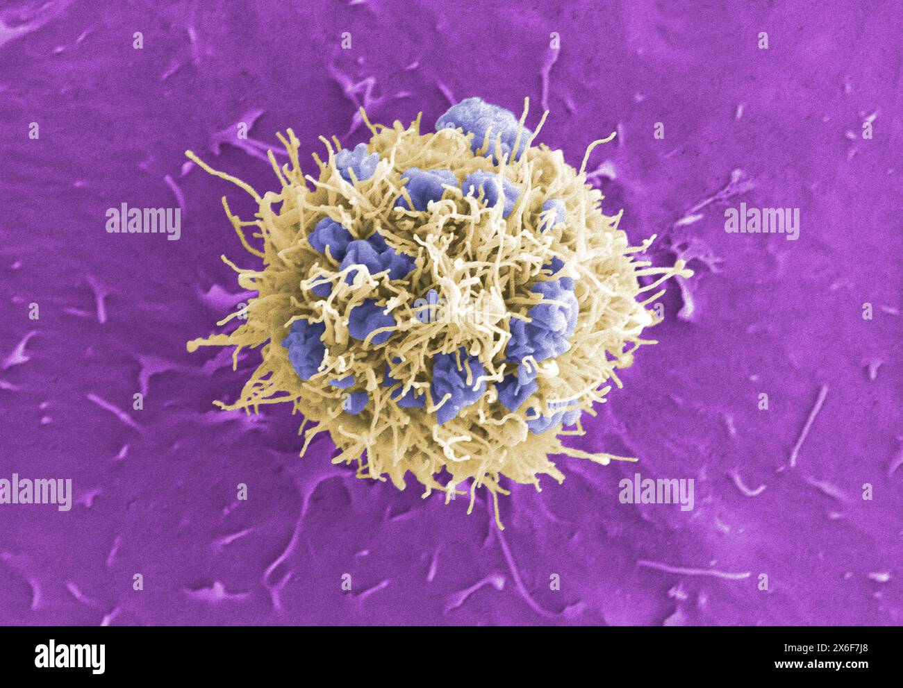 Cervical cancer cell, coloured scanning electron micrograph (SEM). The ...