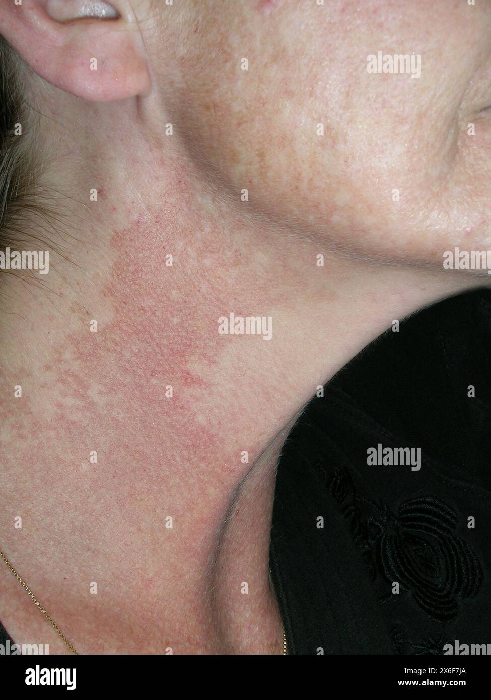 Neck of a 54 year old white female patient with Poikiloderma of Civatte ...