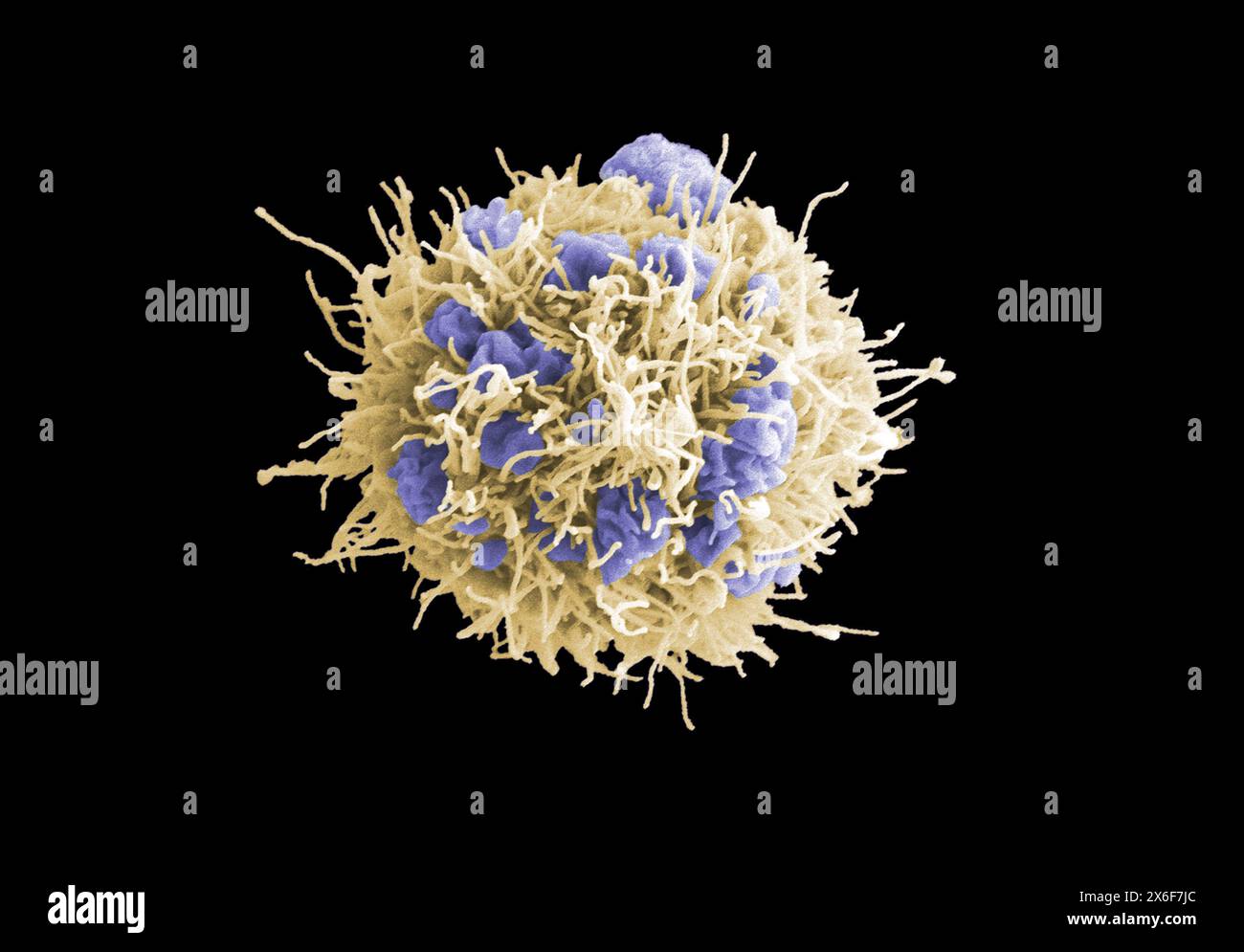 Cervical cancer cell, coloured scanning electron micrograph (SEM). The ...