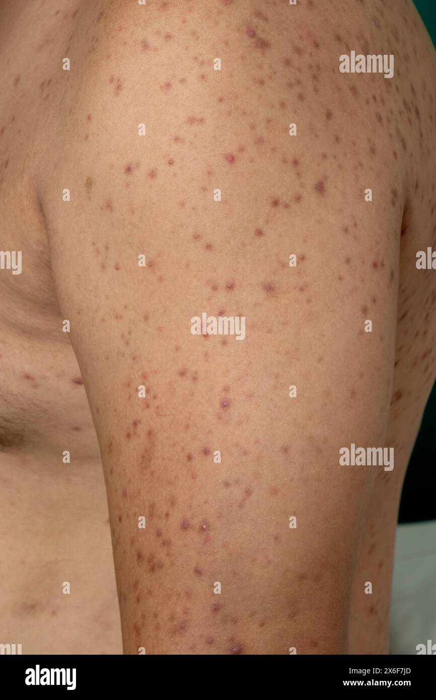 Acne vulgaris on a male patient's shoulder and upper chest. Acne is a ...