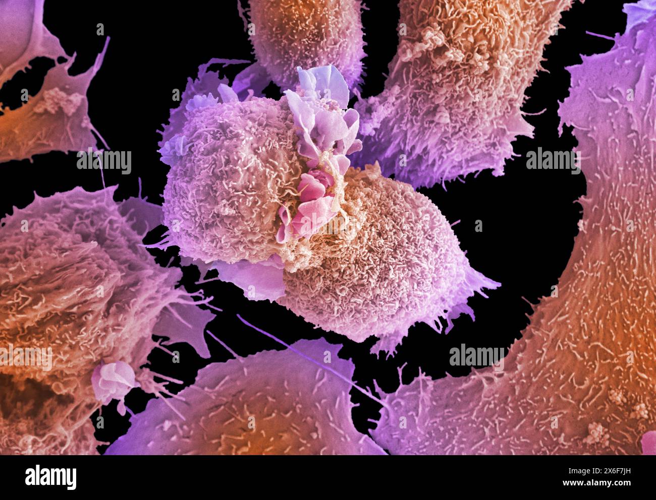 Lung cancer cells, coloured scanning electron micrograph (SEM). Lung ...